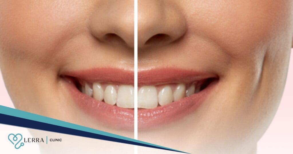 Dimple Creation Surgery: Adding Charm to Your Smile - Lerra Clinic ...