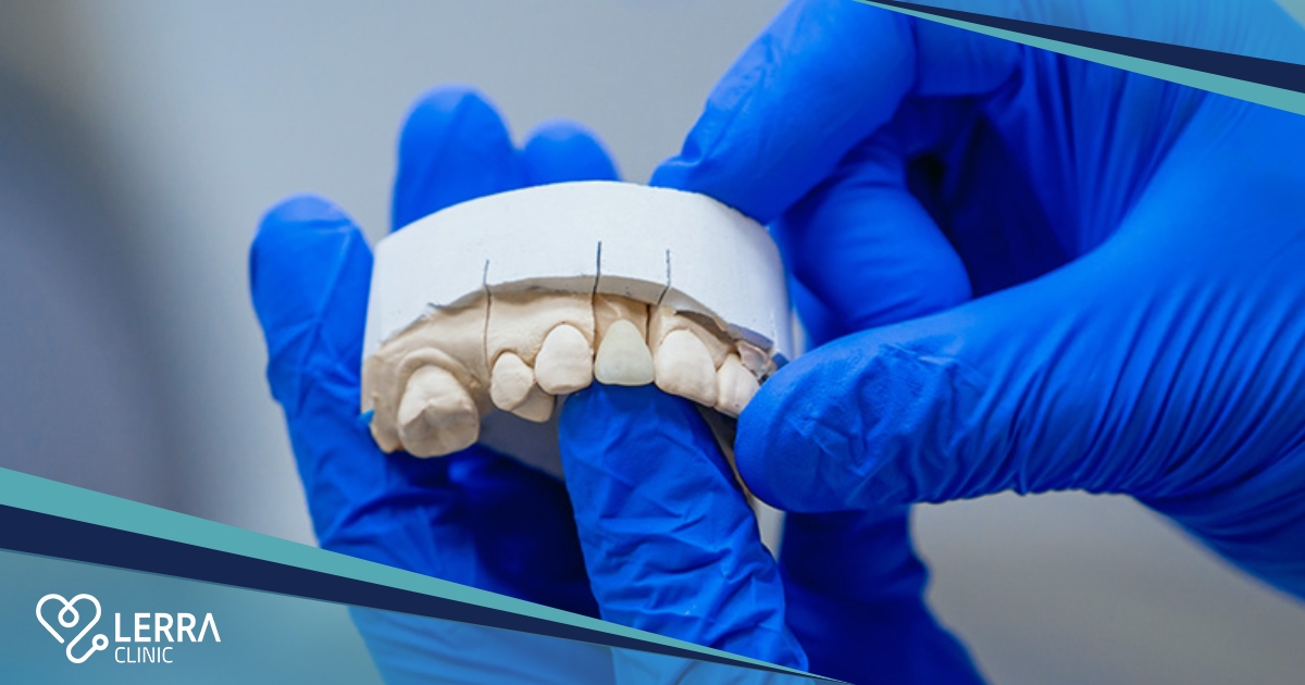 Dental Prosthetic in Türkiye: A Complete Guide to Smile Restoration ...