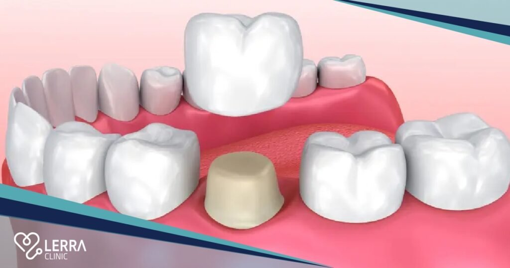 How Long Do Dental Crowns Last? A Complete Guide to Lifespan, Materials ...